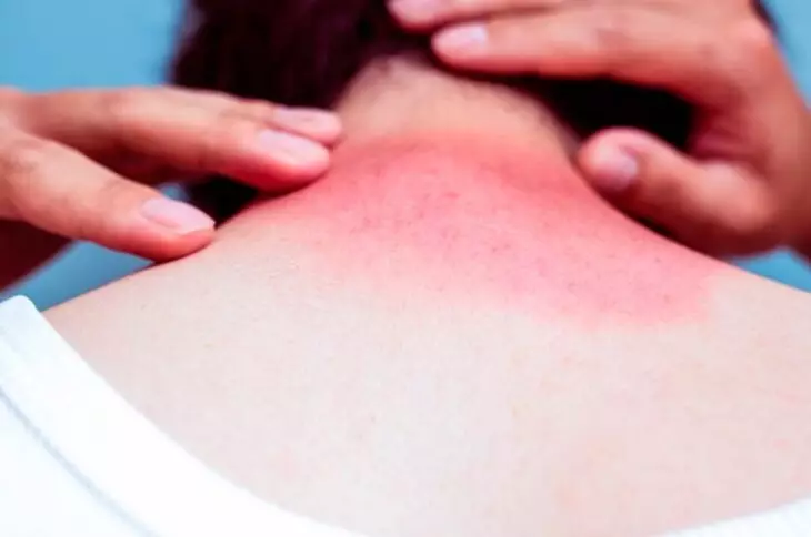 6 häufige Hautprobleme im Sommer und wie man sie vermeidet 10275_1