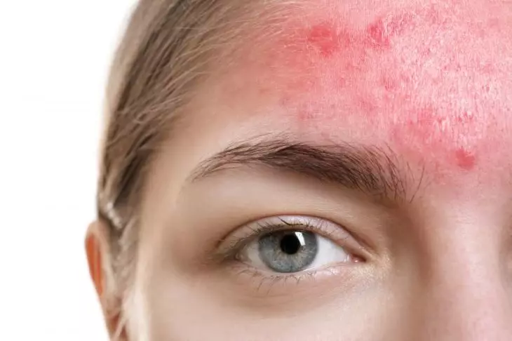 6 häufige Hautprobleme im Sommer und wie man sie vermeidet 10275_2
