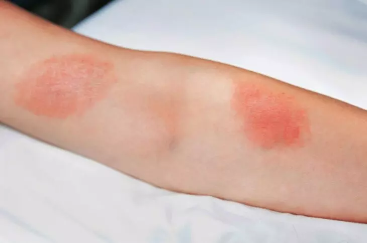 6 вообичаени летни проблеми со кожата и како да ги спречите 10275_3