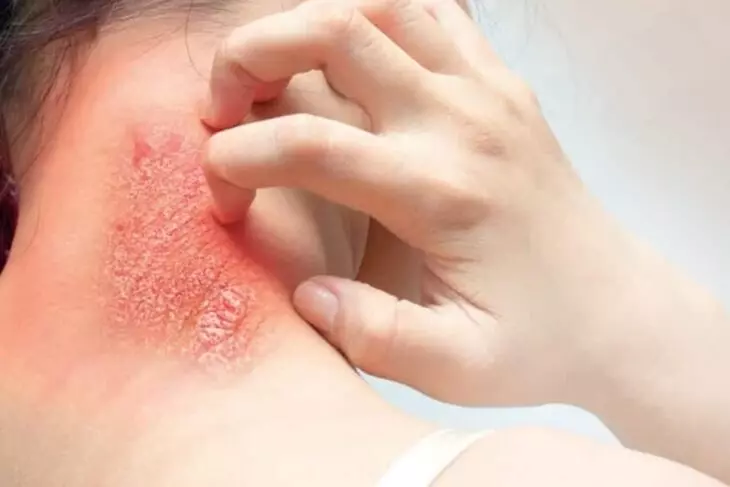 6 вообичаени летни проблеми со кожата и како да ги спречите 10275_5