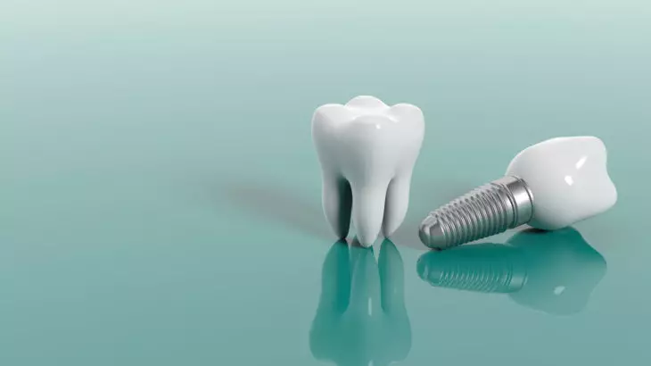 Како зубни имплантати могу направити разлику у вашем животу 10648_2