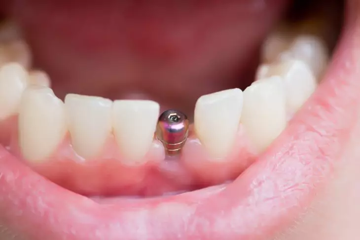 Како зубни имплантати могу направити разлику у вашем животу 10648_3