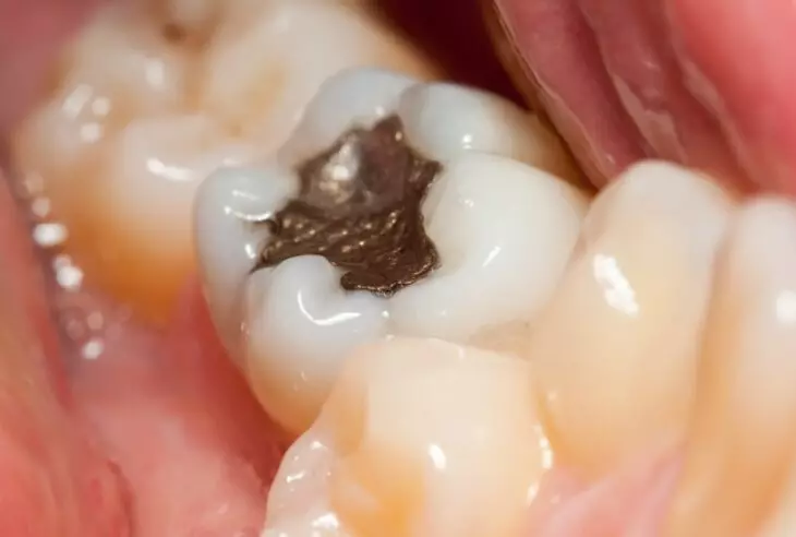 Ատամների լցոնման 5 տարբեր տեսակների ձեր ուղեցույցը 10811_1