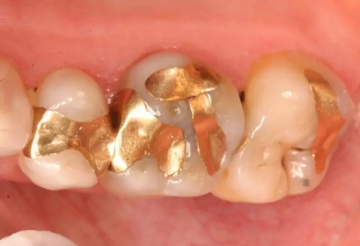 Váš sprievodca 5 rôznymi typmi zubných výplní 10811_2