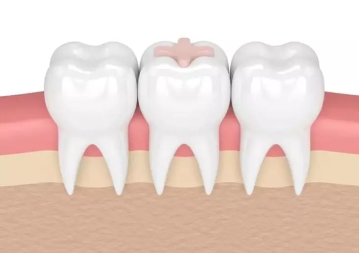 Váš sprievodca 5 rôznymi typmi zubných výplní 10811_5
