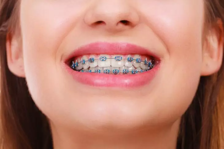 braces حاصل ڪرڻ جي قيمت ڪيتري آهي؟ 10820_2