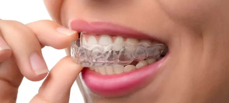 braces حاصل ڪرڻ جي قيمت ڪيتري آهي؟ 10820_5