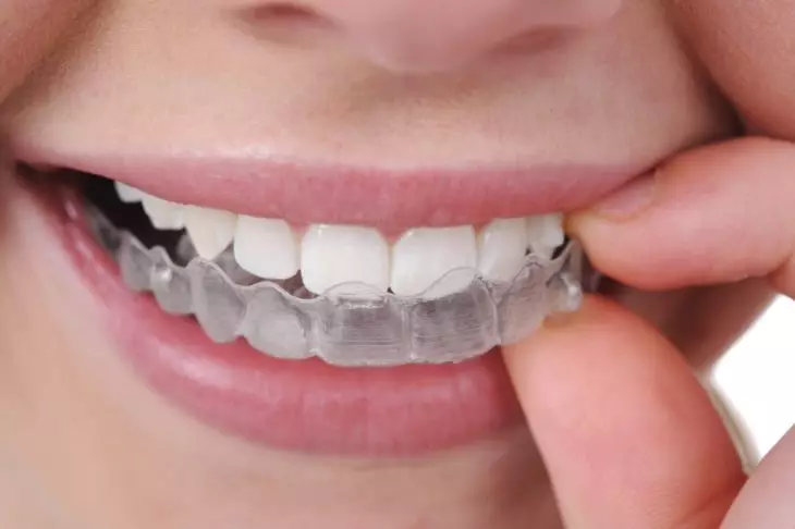 braces پائڻ جي باري ۾ سڀڪنھن شيء کي اوھان کي ڄاڻڻ جي ضرورت آهي 10821_2