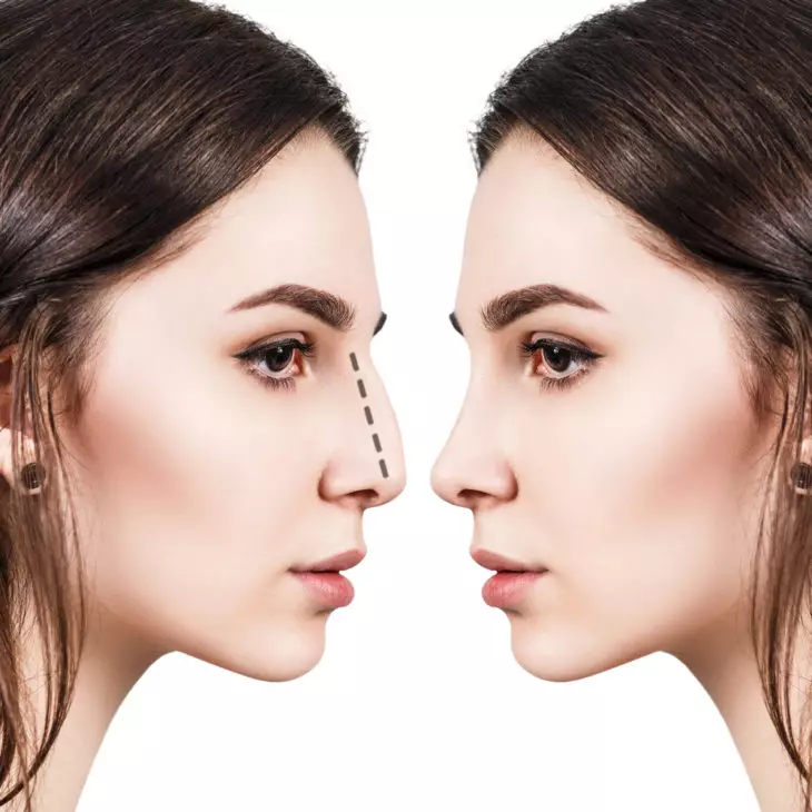 Rhinoplasty na-abụghị nke ịwa ahụ: Ihe 7 I Kwesịrị Ịma Tupu Ị Ga n'ihu 12490_1