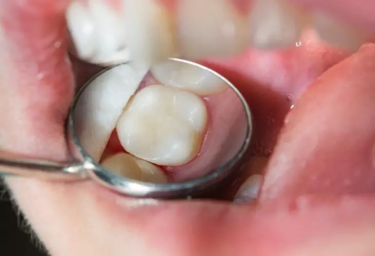 Hampaiden puhdistuksen perustarvikkeet – kaikki mitä sinun tarvitsee tietää 13045_2