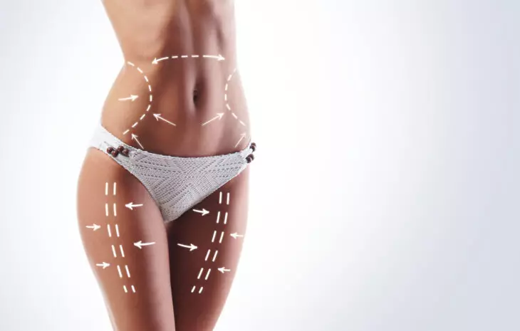6 tips om uw liposuctieherstel te verbeteren 14714_1