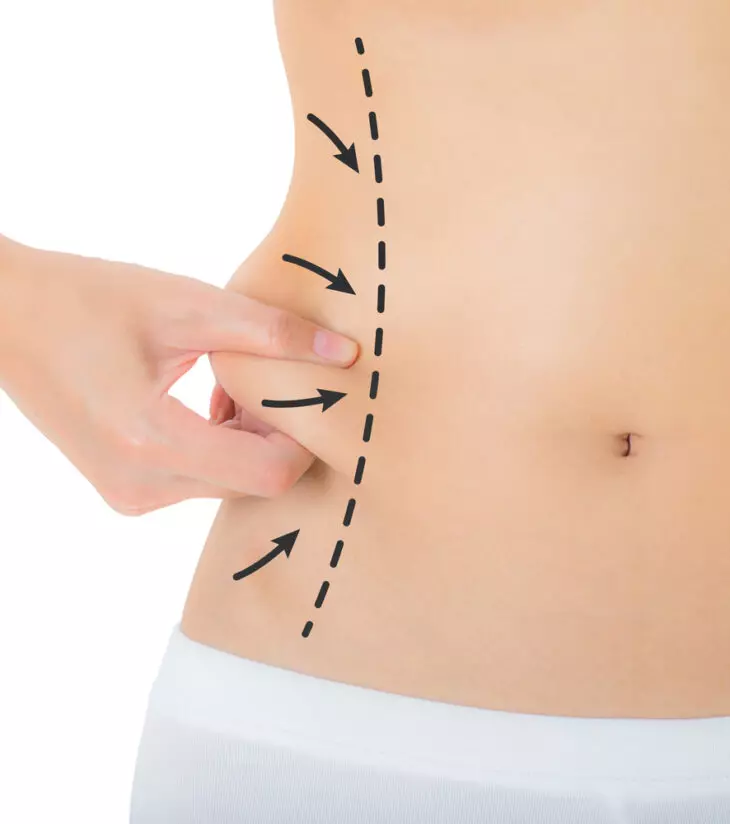 6 tips om uw liposuctieherstel te verbeteren 14714_4