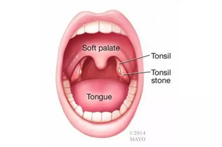 Gross Talk: You Pop Your Tonsil Stones; 16216_1