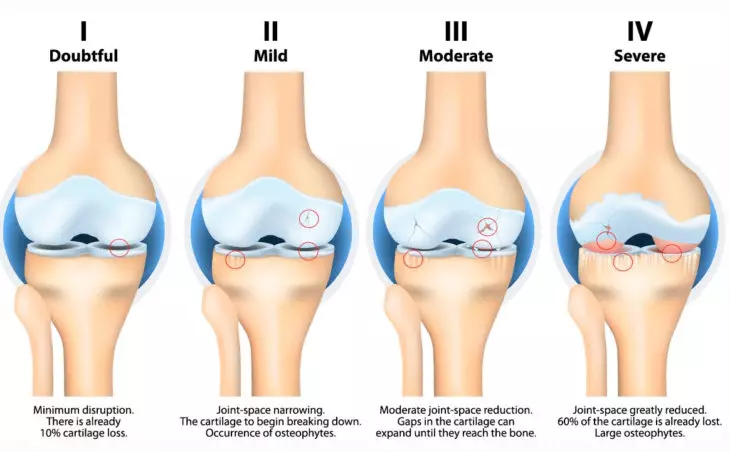 Sakit sa Tuhod at Osteoarthritis ng tuhod: Hindi maiiwasan sa mga matatanda? 16530_2