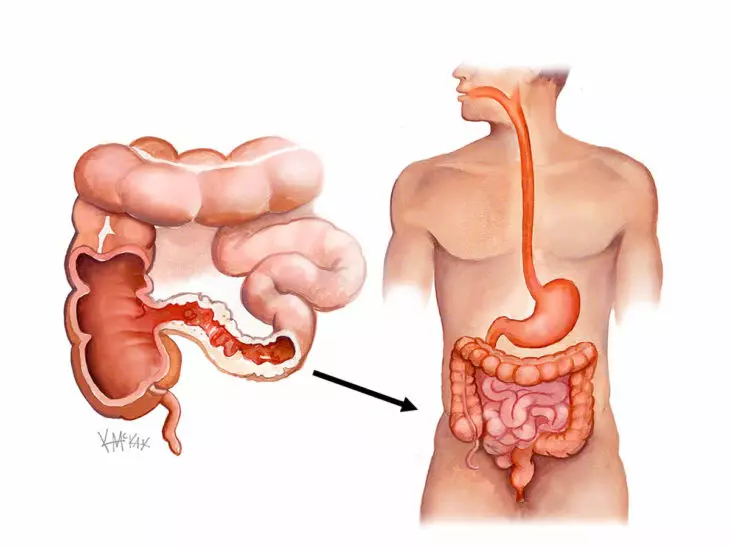 Cudurka Crohn - sababaha, calaamadaha, iyo daaweynta 16533_1