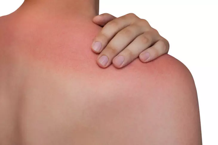 Efectele expunerii la soare asupra pielii tale 16579_3