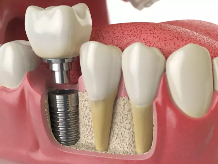 7 Avantaje și dezavantaje ale implanturilor dentare 16633_7