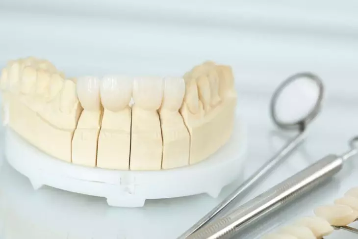 Dental Veneers: alles wat u erover moet weten 16637_1