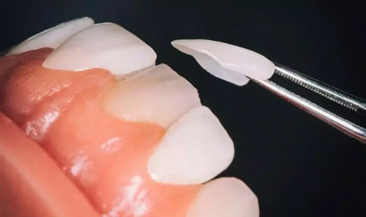 Facetas dentárias: tudo o que você precisa saber sobre elas 16637_4