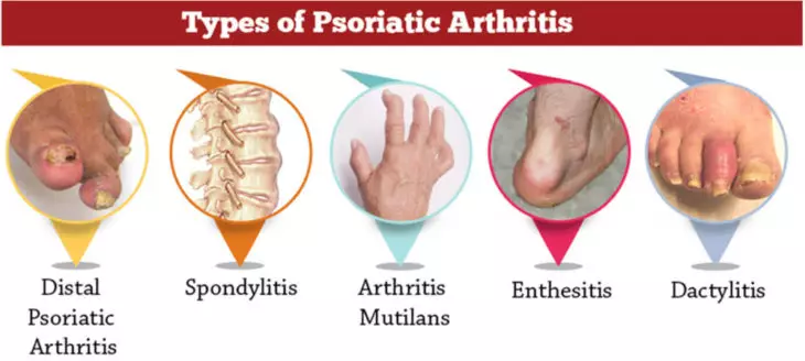 Indlela yokulwa ne-psoriatic arthritis 16702_1