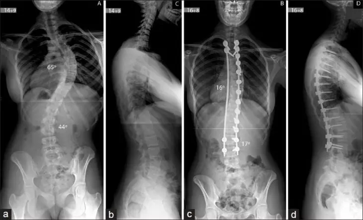 Mayroon Akong Malubhang Scoliosis, Katulad ng Aking Nanay 18377_4