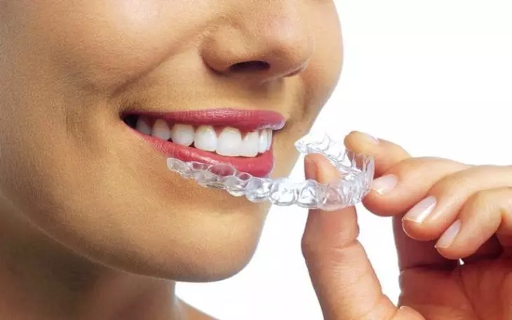 Unsichtbare Zahnspangen von Invisalign: Was Sie vor und nach der Behandlung erwarten können 18645_2