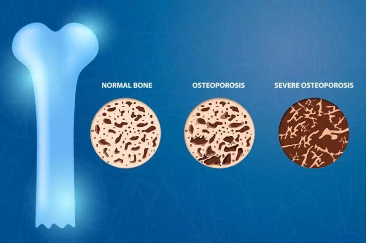 Viskas, ką reikia žinoti apie osteoporozę 20867_1