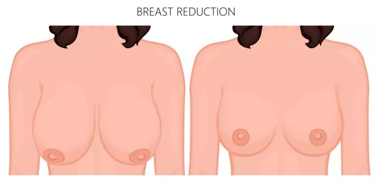 मुलीची चर्चा: माझी स्तन कमी करण्याची शस्त्रक्रिया का झाली 22475_1