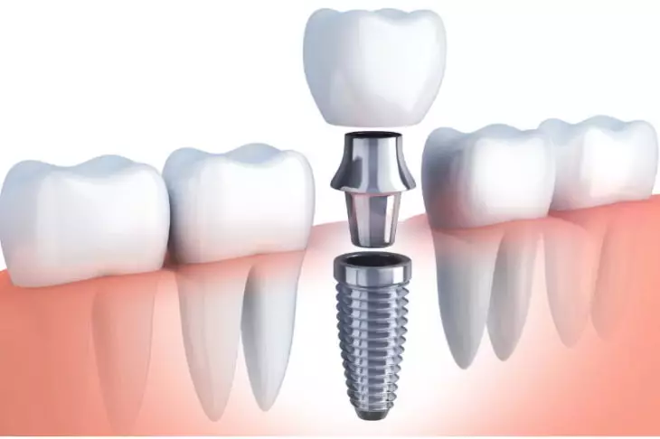 Implantes dentais en Turquía 2279_1
