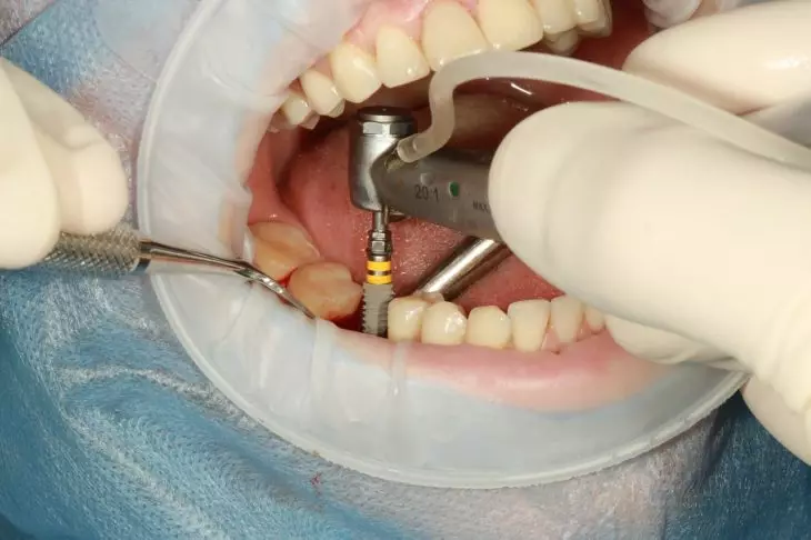 Dental Implants yn Turkije 2279_2