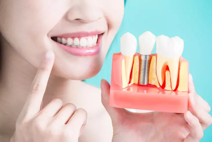 Dental Implants yn Turkije 2279_3
