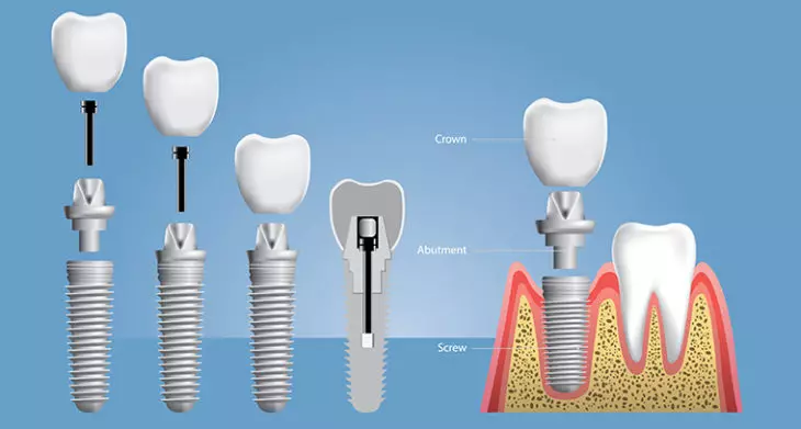 Dental Implants yn Turkije 2279_4