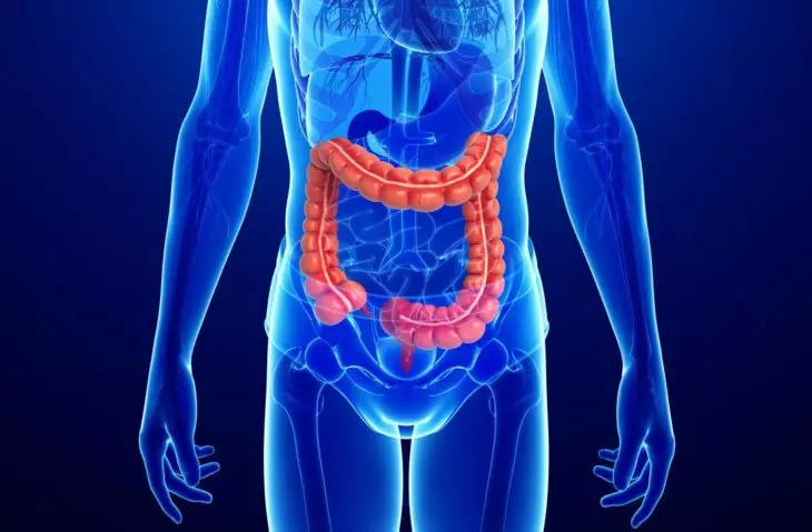 Hvernig á að berjast gegn Crohns sjúkdómi 23332_1