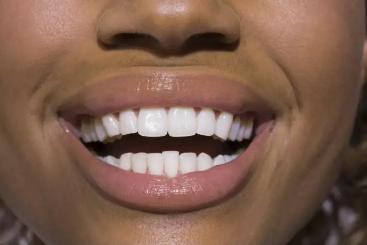 החזר את החיוך המושלם שלך - איך להלבין את השיניים שלך 25066_2