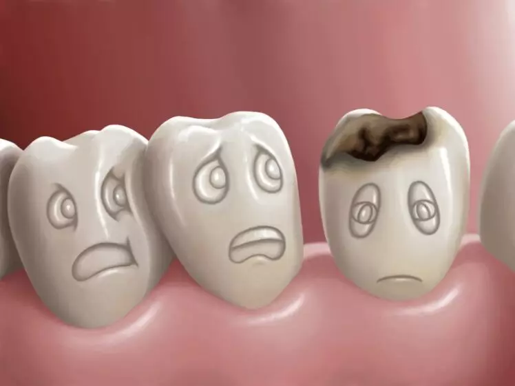 So erkennen und reparieren Sie Zahnkavitäten – Leitfaden 2022