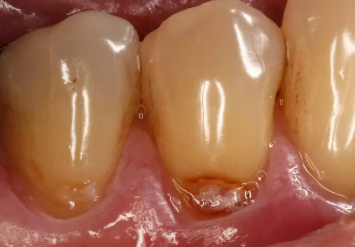 Diş Boşluğu Nasıl Tespit Edilir ve Düzeltilir - 2022 Kılavuzu 25_1