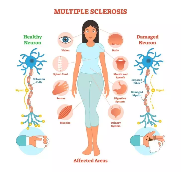 Ndine Multiple Sclerosis 26512_2