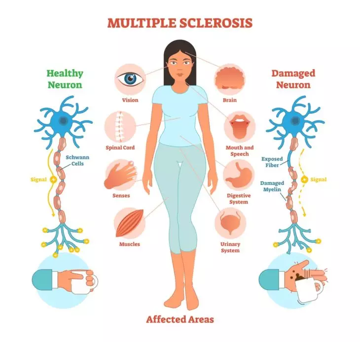 Mayroon akong Multiple Sclerosis 26512_2