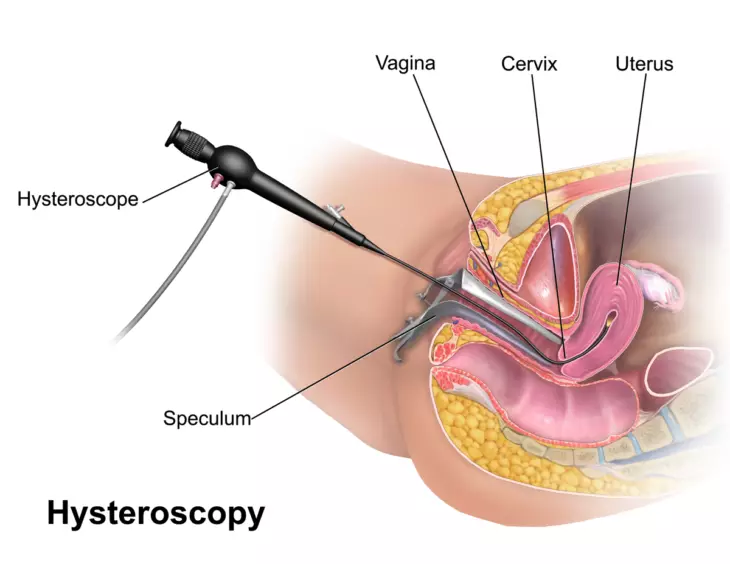 Historia real: tuve un pólipo uterino masivo 26574_2