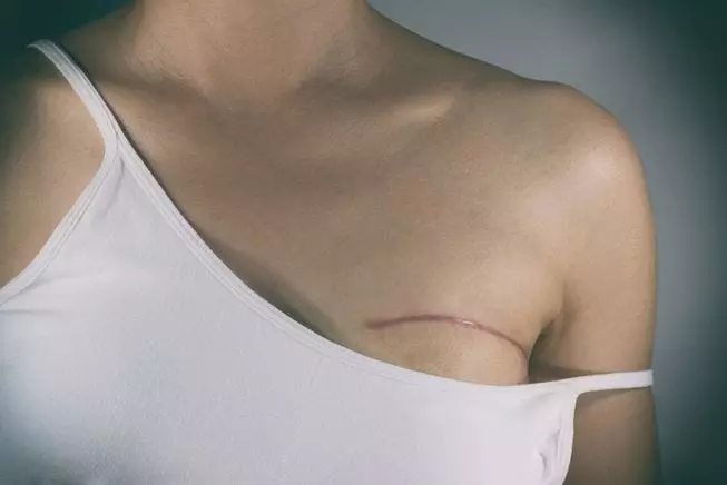 Mastectomy کان پوءِ ملاقات 26897_1