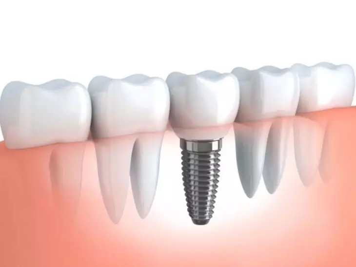 Onde obter plans de pago de implantes dentais accesibles en 2022 27719_9