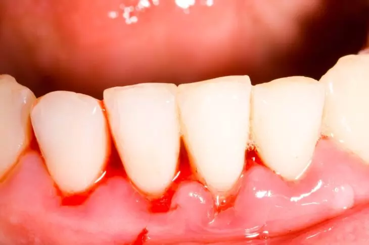 健康診断：歯茎から出血するのはなぜですか？心配する必要がありますか？ 28066_3