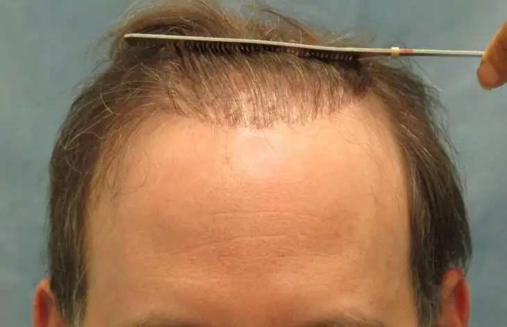 Der Unterschied zwischen FUE- und FUT-Haartransplantationen 28094_1
