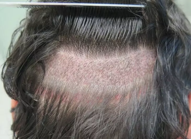 Der Unterschied zwischen FUE- und FUT-Haartransplantationen 28094_2