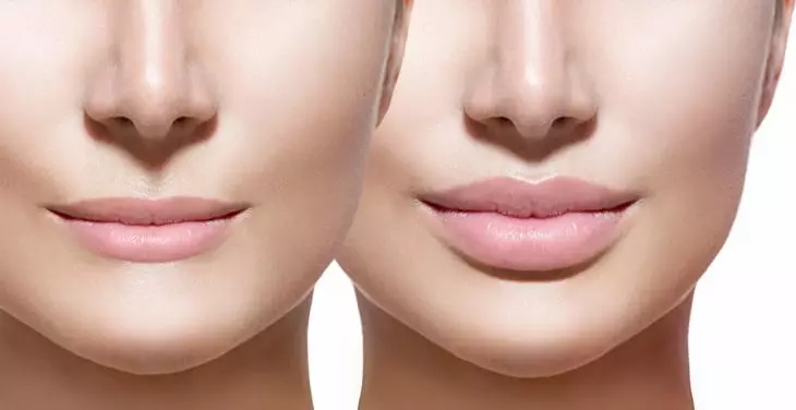 4 Cara Pengisi Dermal Boleh Mengubah Rupa Bibir Anda 30472_2