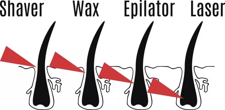 Ən yaxşı epilyasiya üsulları 31686_1