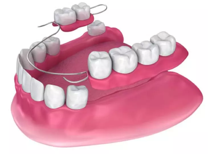 Dentadura: motak eta onurak 32262_1