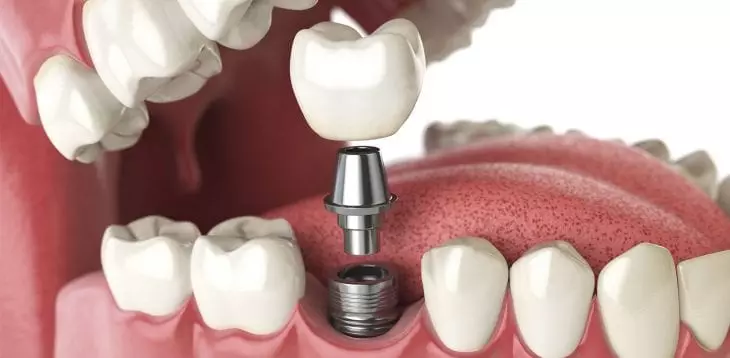 Implantes dentários: tipos e vantagens 32568_1