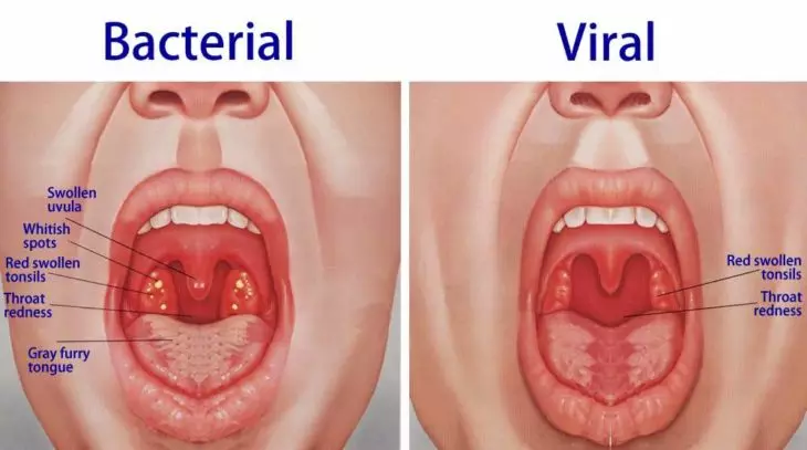 Ny zava-drehetra tokony ho fantatrao momba ny otrikaretina bakteria amin'ny tenda ary raha toa ka mifindra ny tonsillitis 32582_1