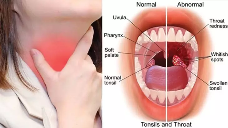 Ny zava-drehetra tokony ho fantatrao momba ny otrikaretina bakteria amin'ny tenda ary raha toa ka mifindra ny tonsillitis 32582_2